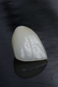 da Vinci Dental Studios | Feldspathic Veneers