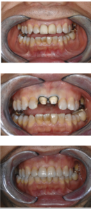 Restorations that Look Natural – da Vinci Dental Studios | Feldspathic Veneers